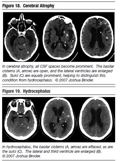 Basal Cistern Effacement
